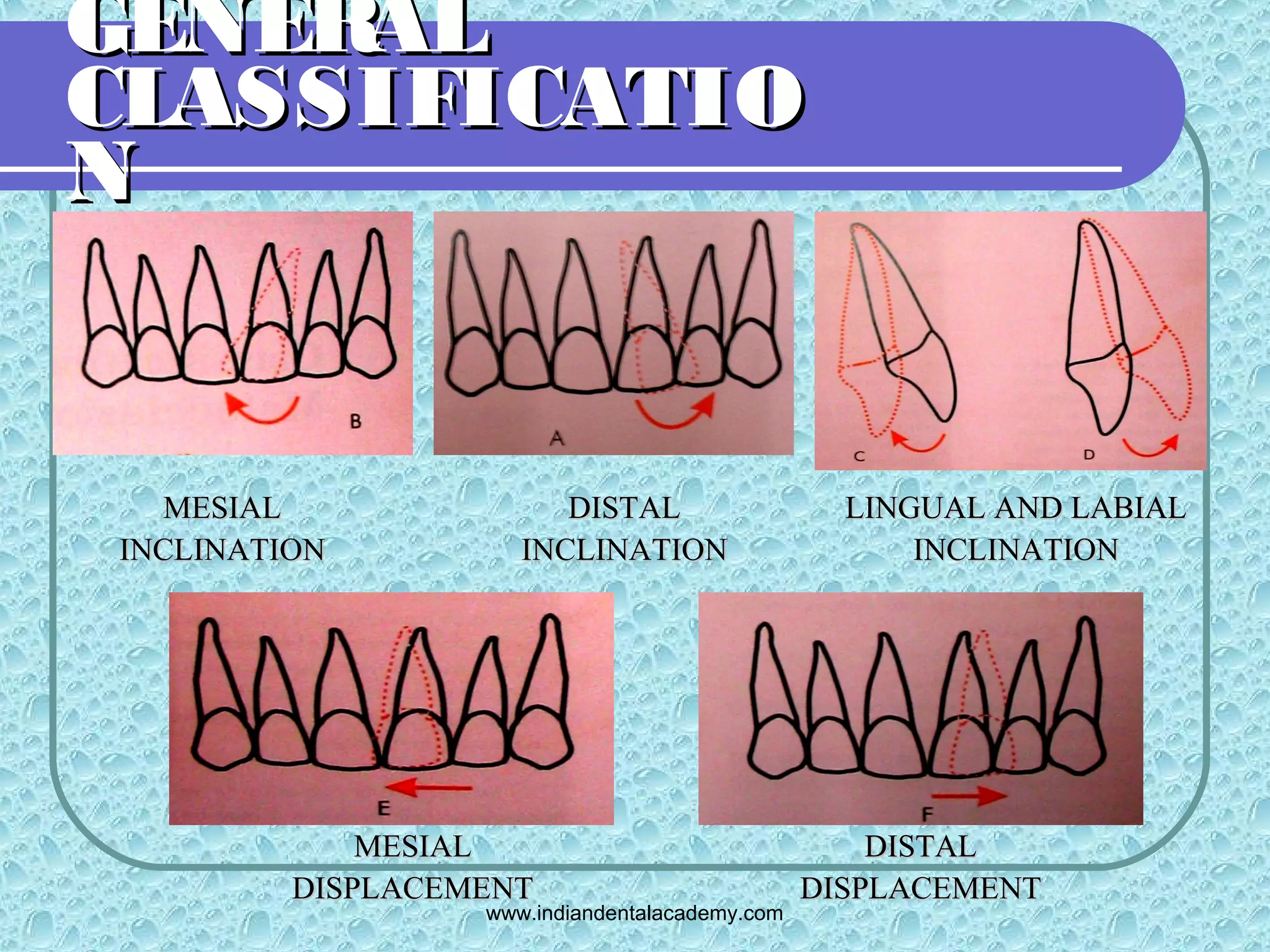 classification of Malocclusion /certified fixed orthodontic courses by ...