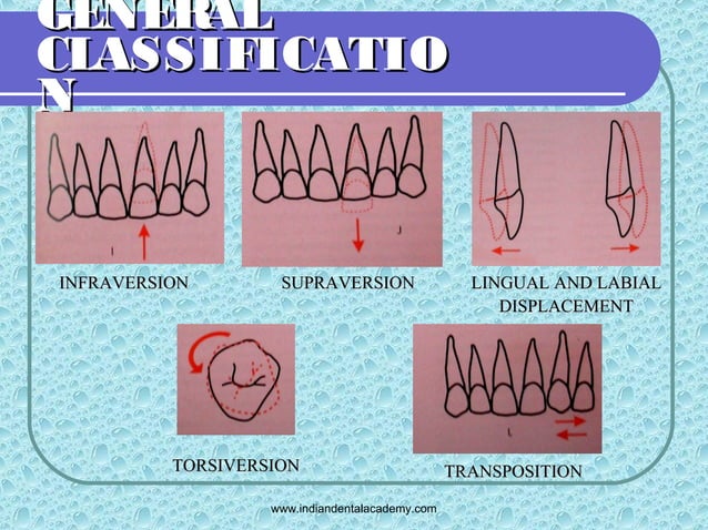 classification of Malocclusion /certified fixed orthodontic courses by ...