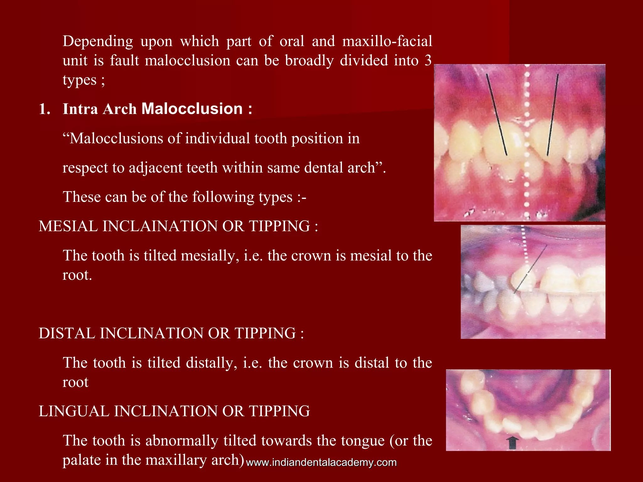 Malocclusion | PPT