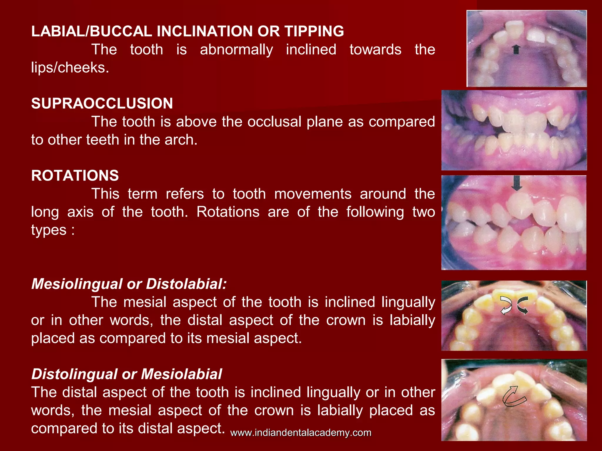Malocclusion | PPT