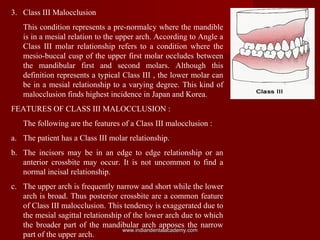 Malocclusion | PPT