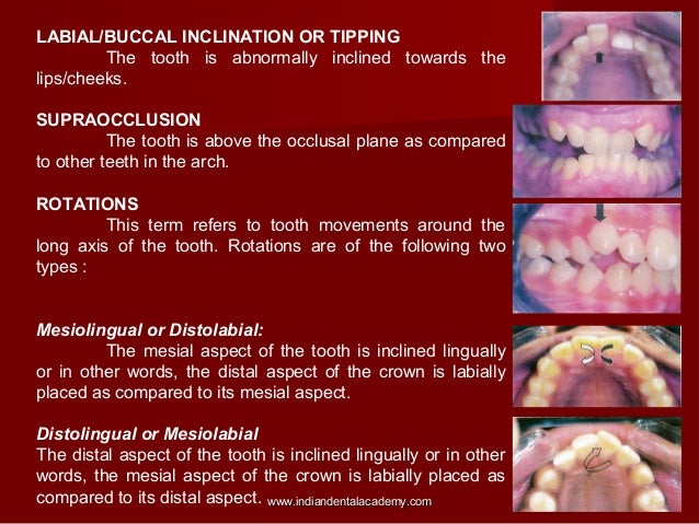Malocclusion