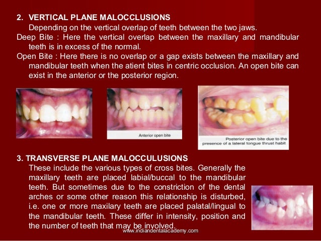 Malocclusion