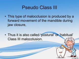 Malocclusion | PPTX