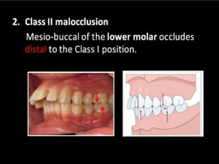 Malocclusion | PPTX