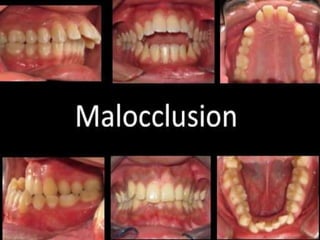 Malocclusion | PPT