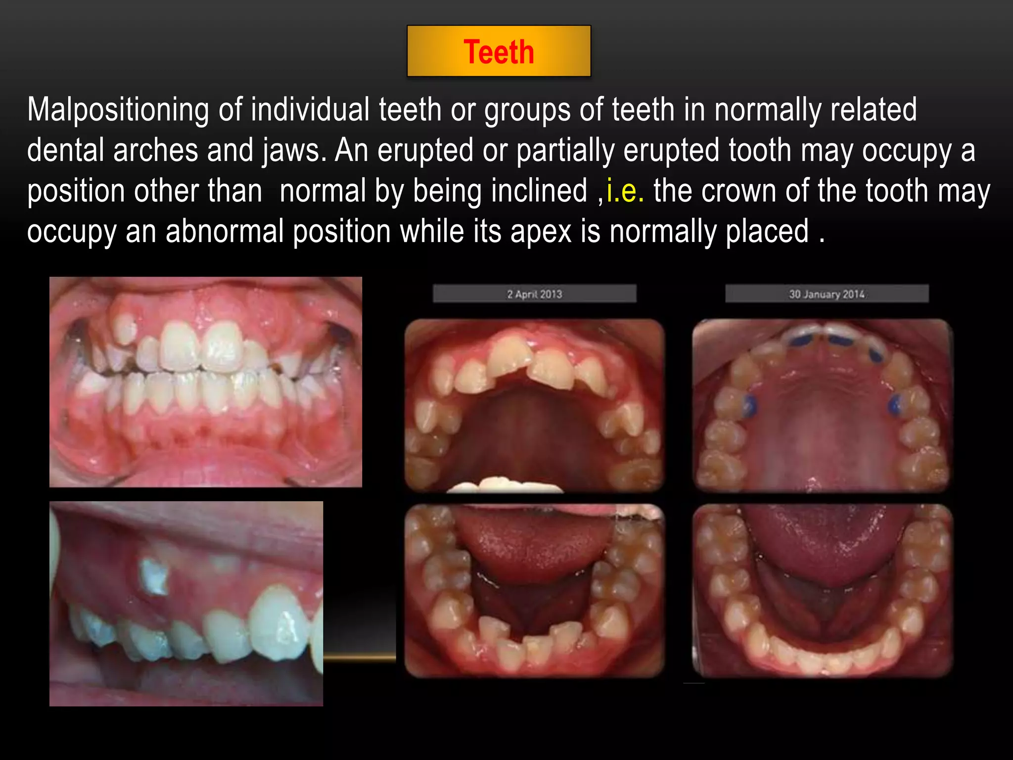 Malocclusion | PPTX
