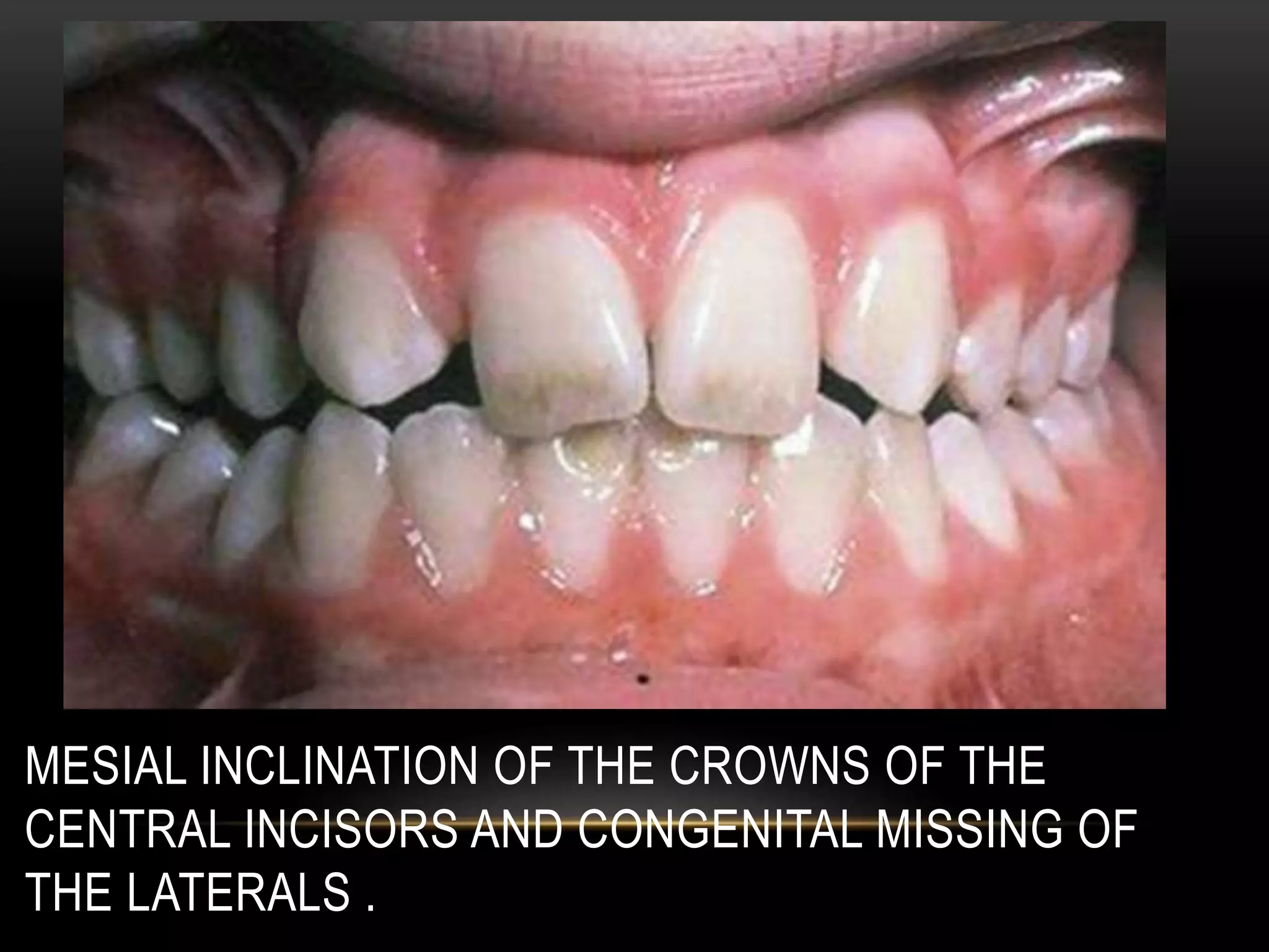 Malocclusion | PPTX