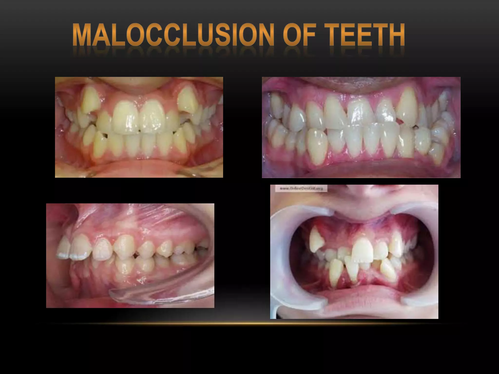 Malocclusion | PPTX