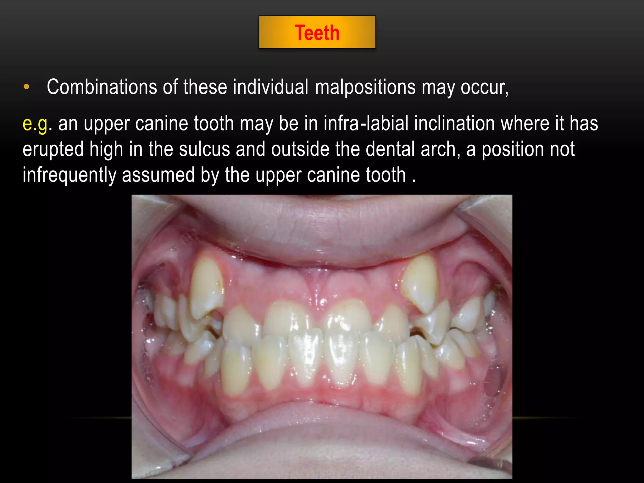 Malocclusion | PPTX
