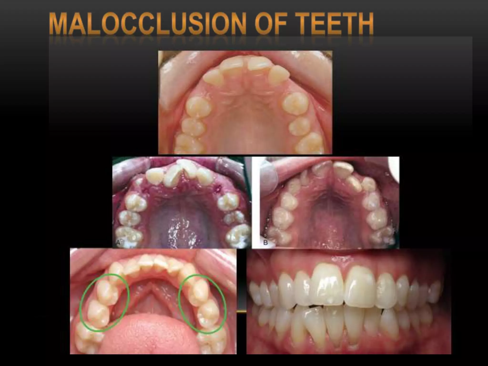 Malocclusion | PPTX