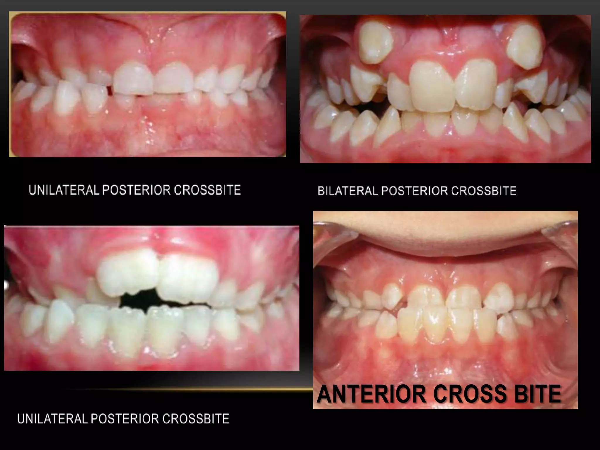 Malocclusion | PPTX