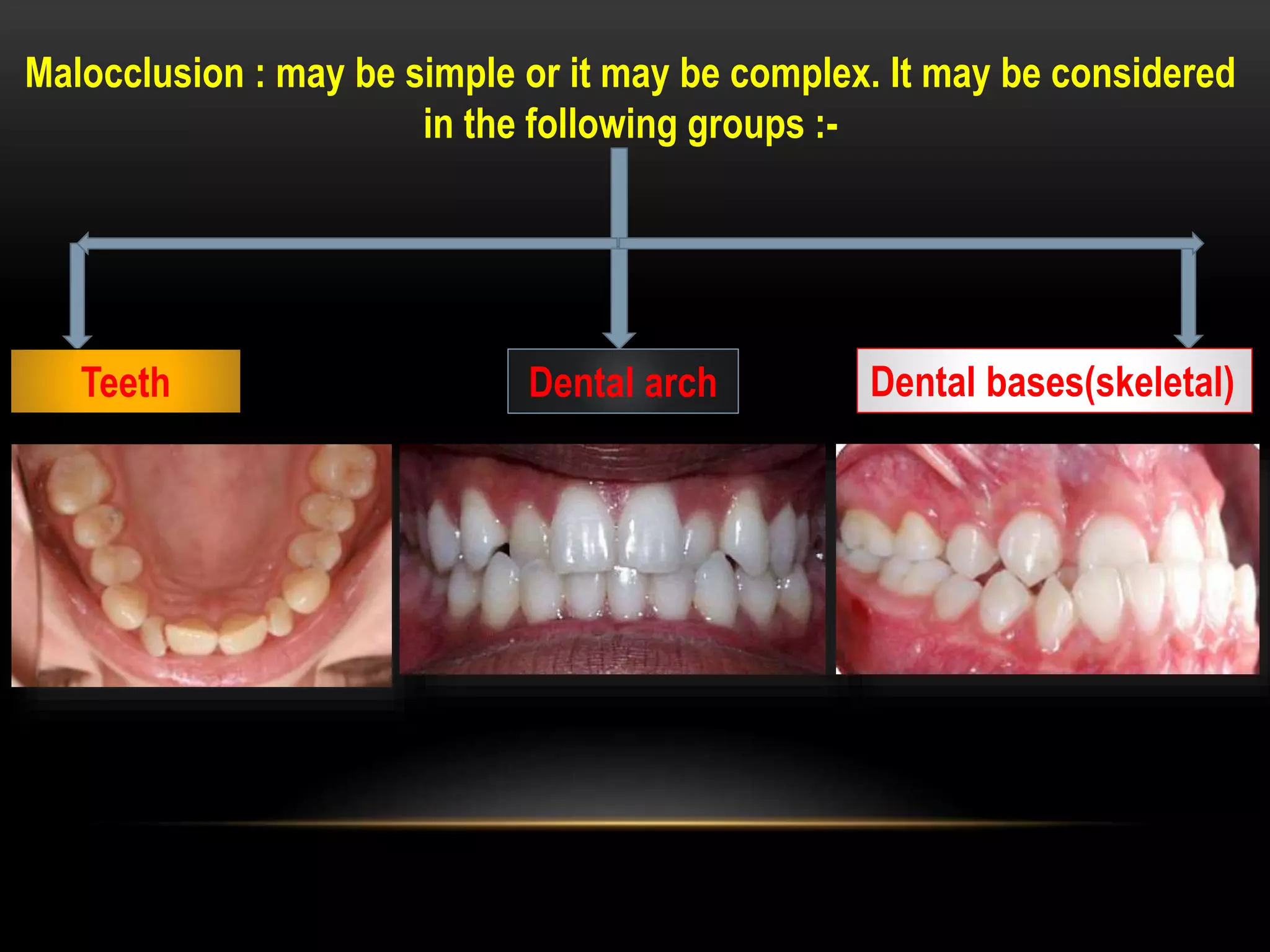 Malocclusion | PPTX