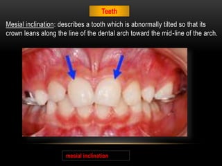 Malocclusion | PPTX