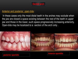 Malocclusion | PPTX