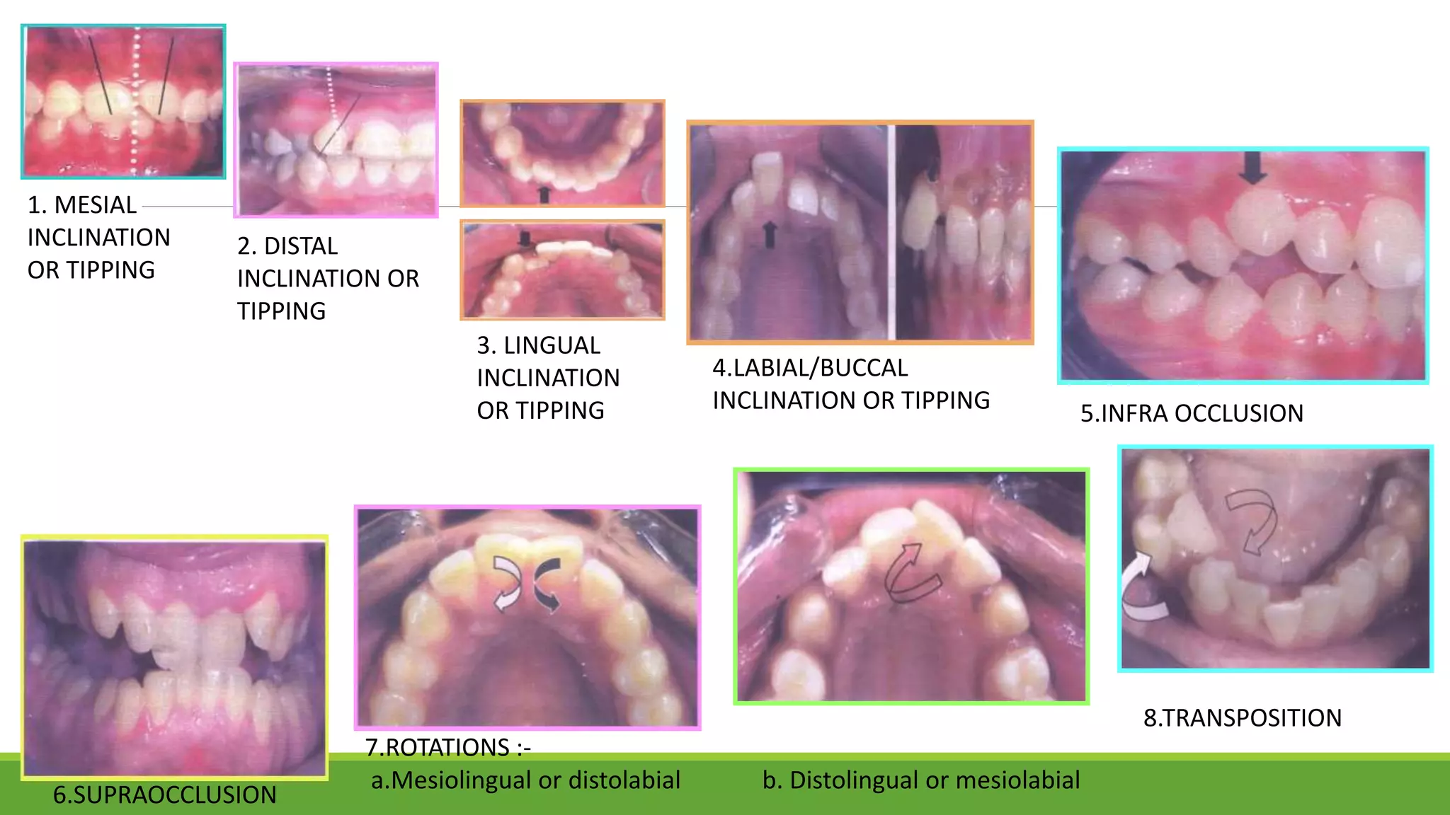Malocclusion & Orthodontic Treatment | PPTX
