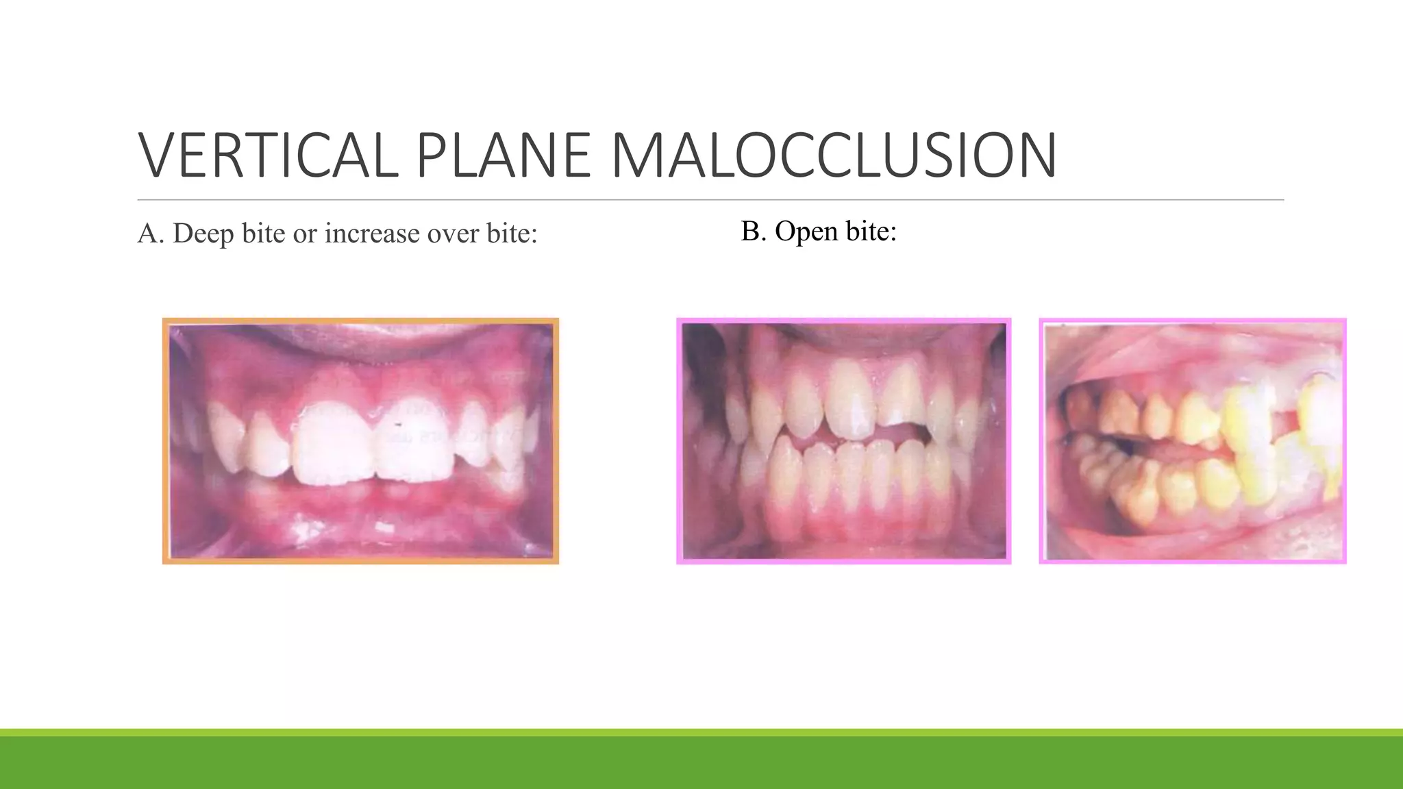 Malocclusion & Orthodontic Treatment | PPTX