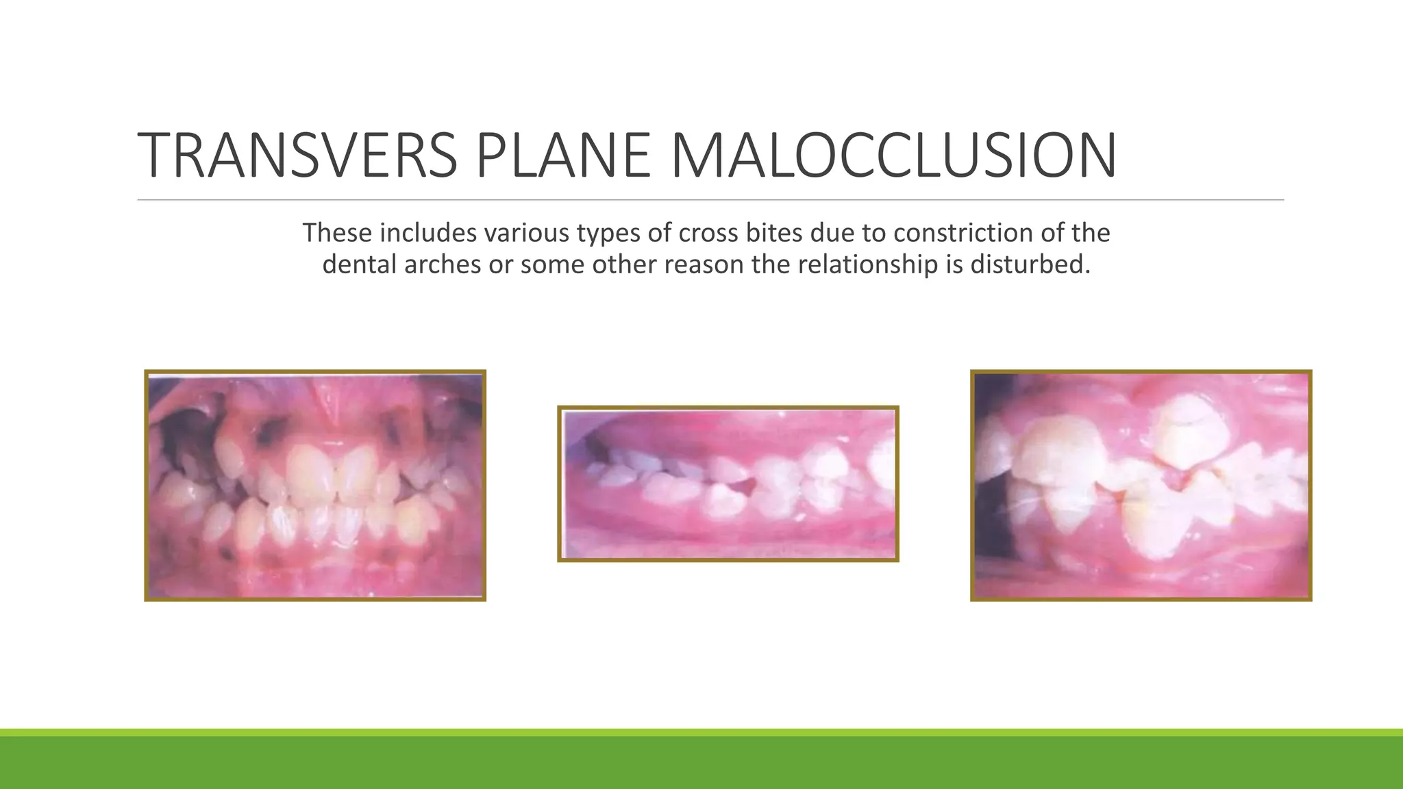 Malocclusion & Orthodontic Treatment | PPTX