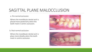 Malocclusion & Orthodontic Treatment | PPTX