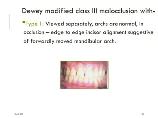 MALOCCLUSION ORTHODONTICS classification.pptx