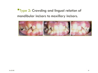 MALOCCLUSION ORTHODONTICS classification.pptx