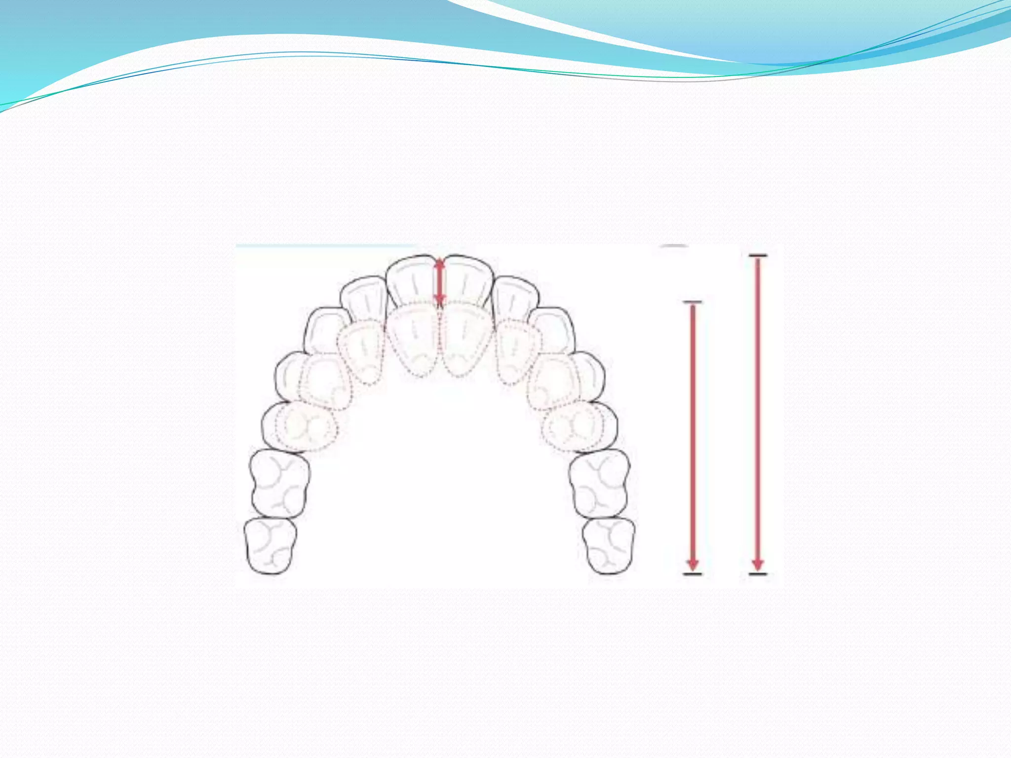 Malocclusion Considerations Regarding Orthodontic Cast Analysis PPTX Malocclusion Considerations Regarding Orthodontic Cast Analysis PPTX