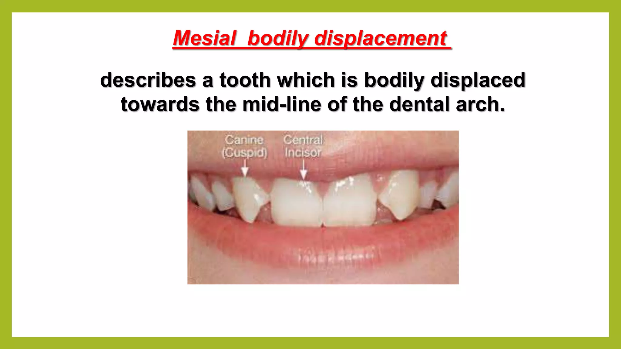 Malocclusion of teeth | PPTX