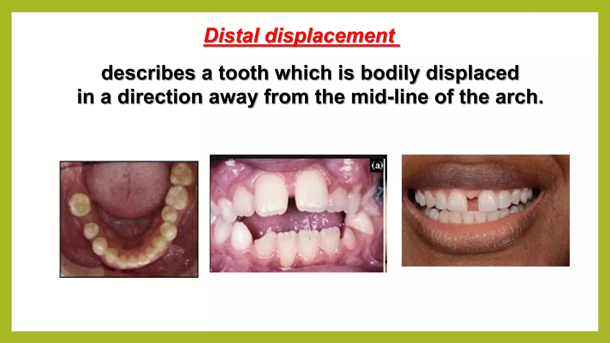 Malocclusion of teeth | PPTX