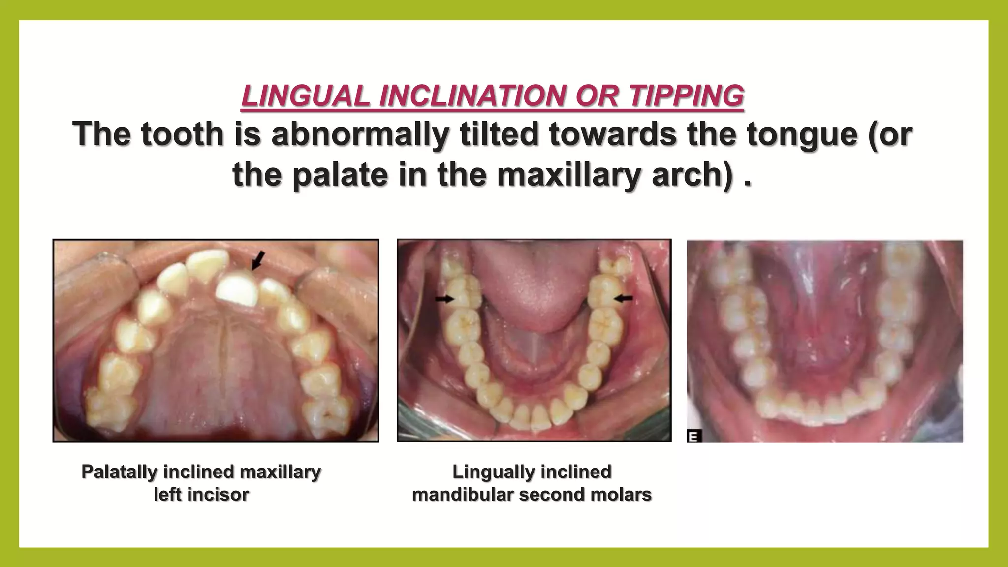 Malocclusion of teeth | PPTX