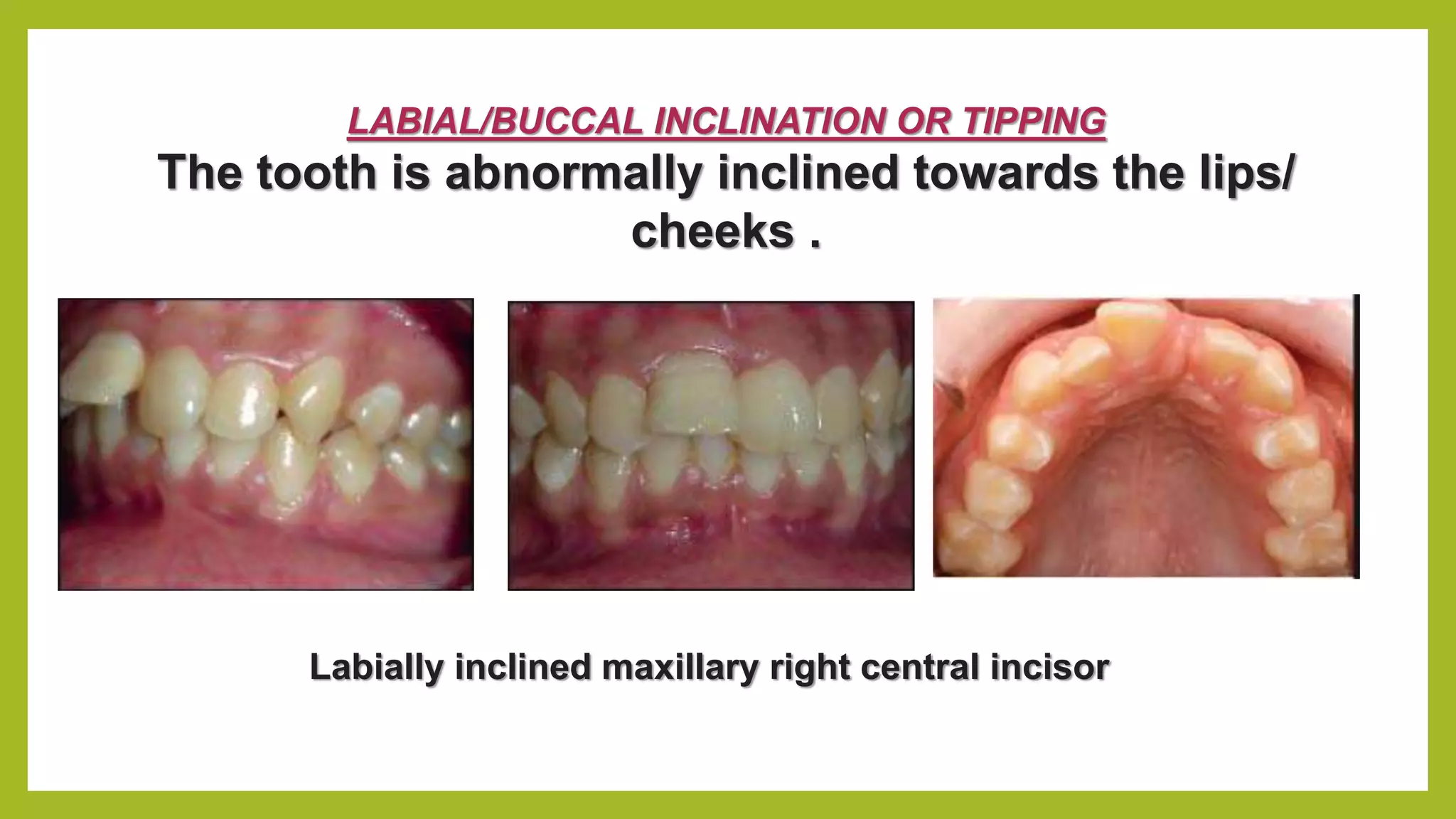 Malocclusion of teeth | PPTX