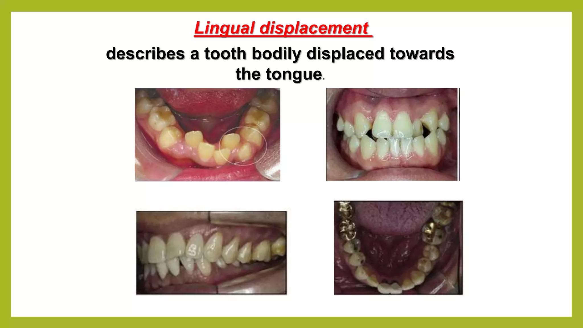 Malocclusion of teeth | PPTX