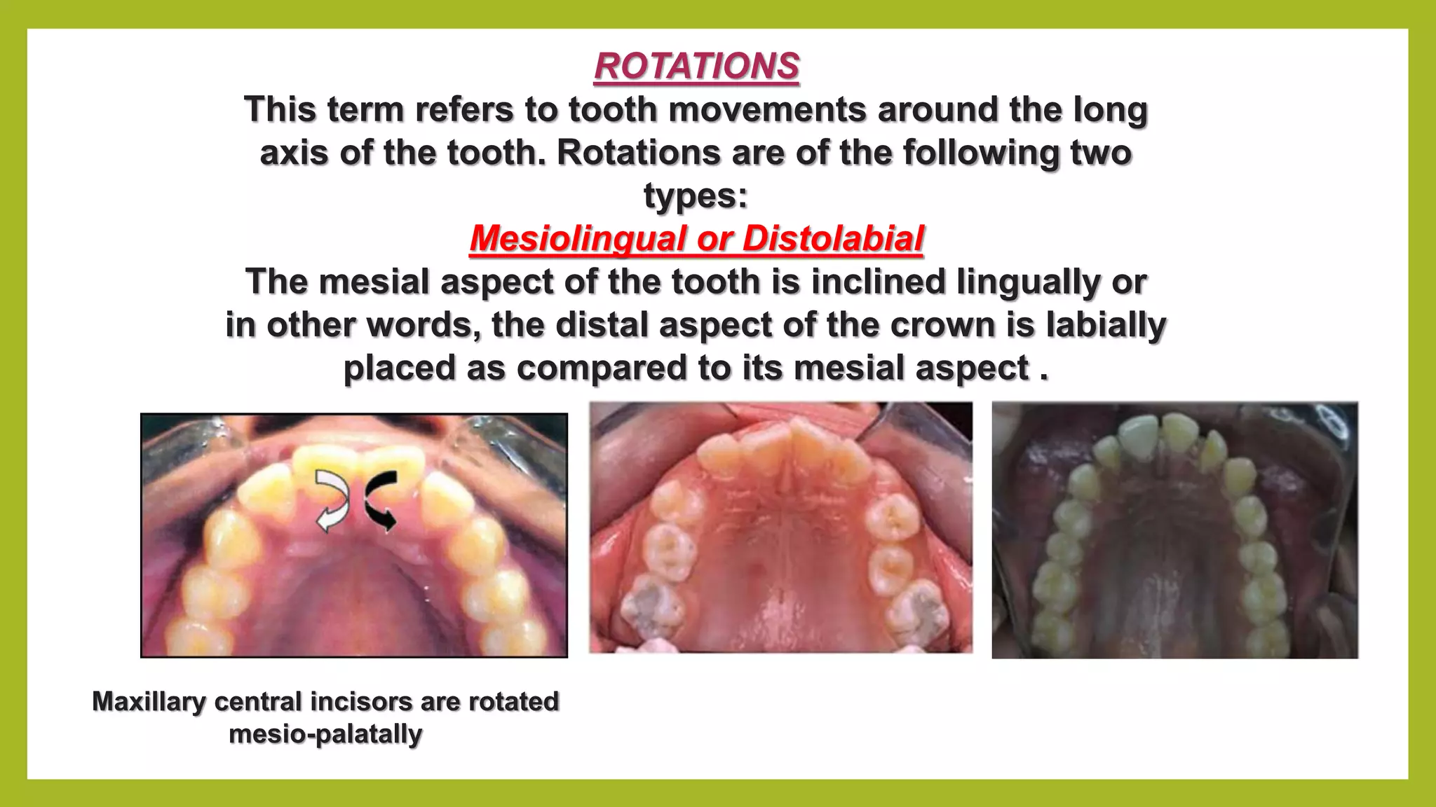 Malocclusion of teeth | PPTX