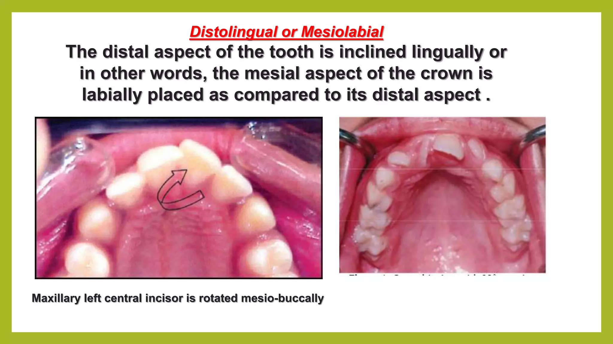 Malocclusion of teeth | PPTX