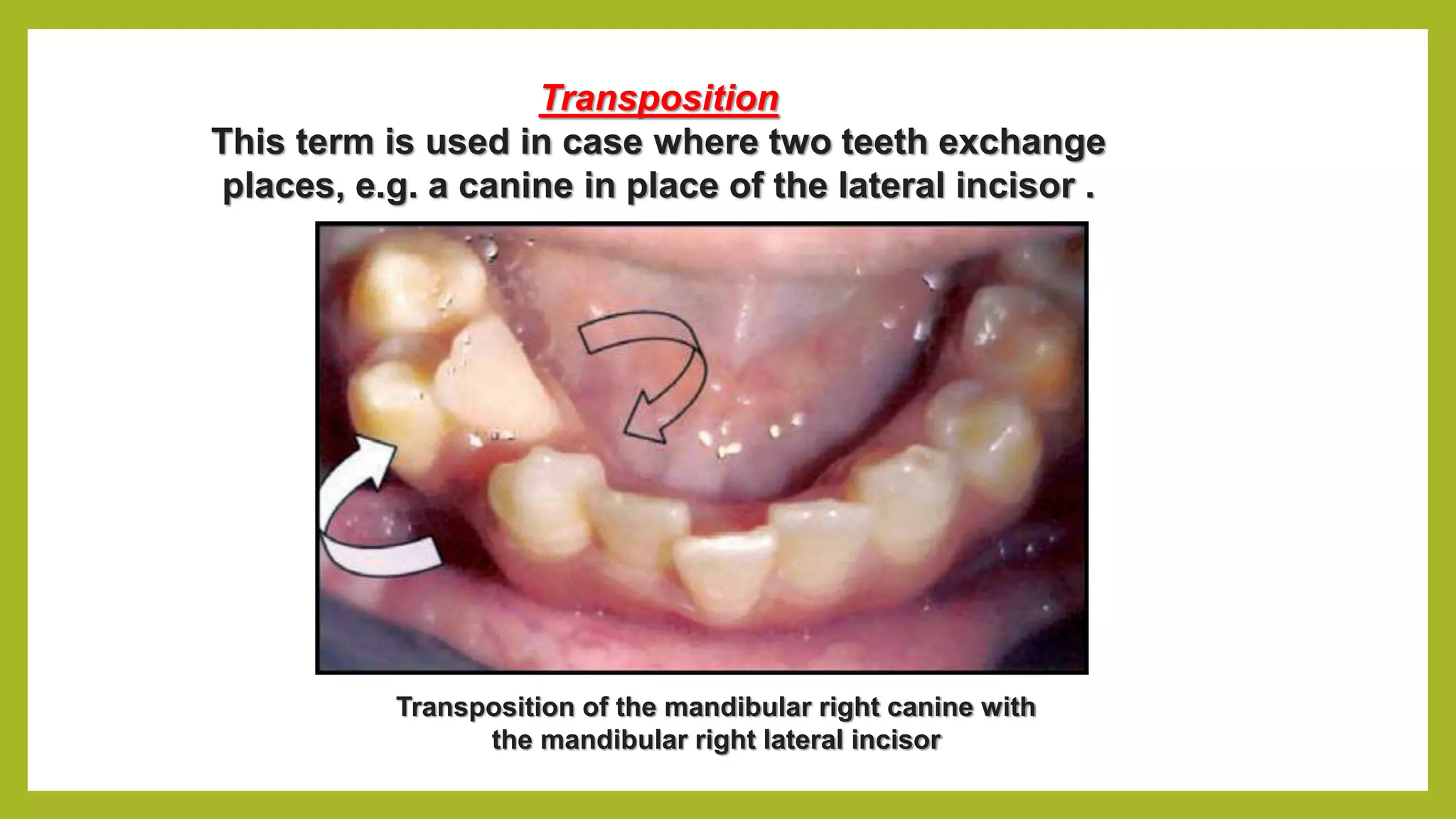 Malocclusion of teeth | PPTX