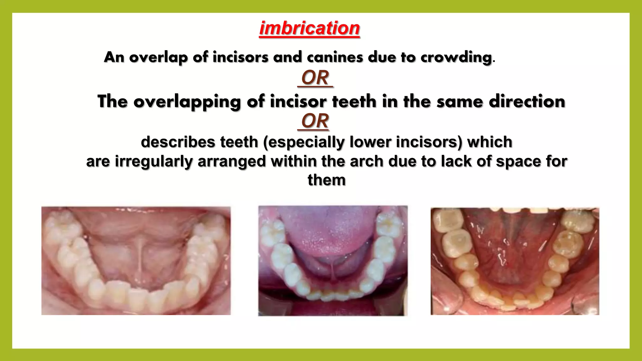 Malocclusion of teeth | PPTX
