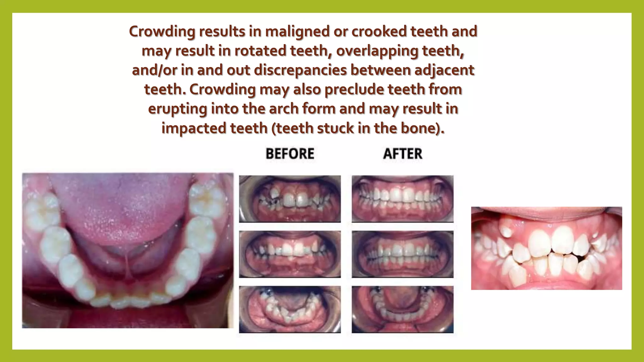 Malocclusion of teeth | PPTX