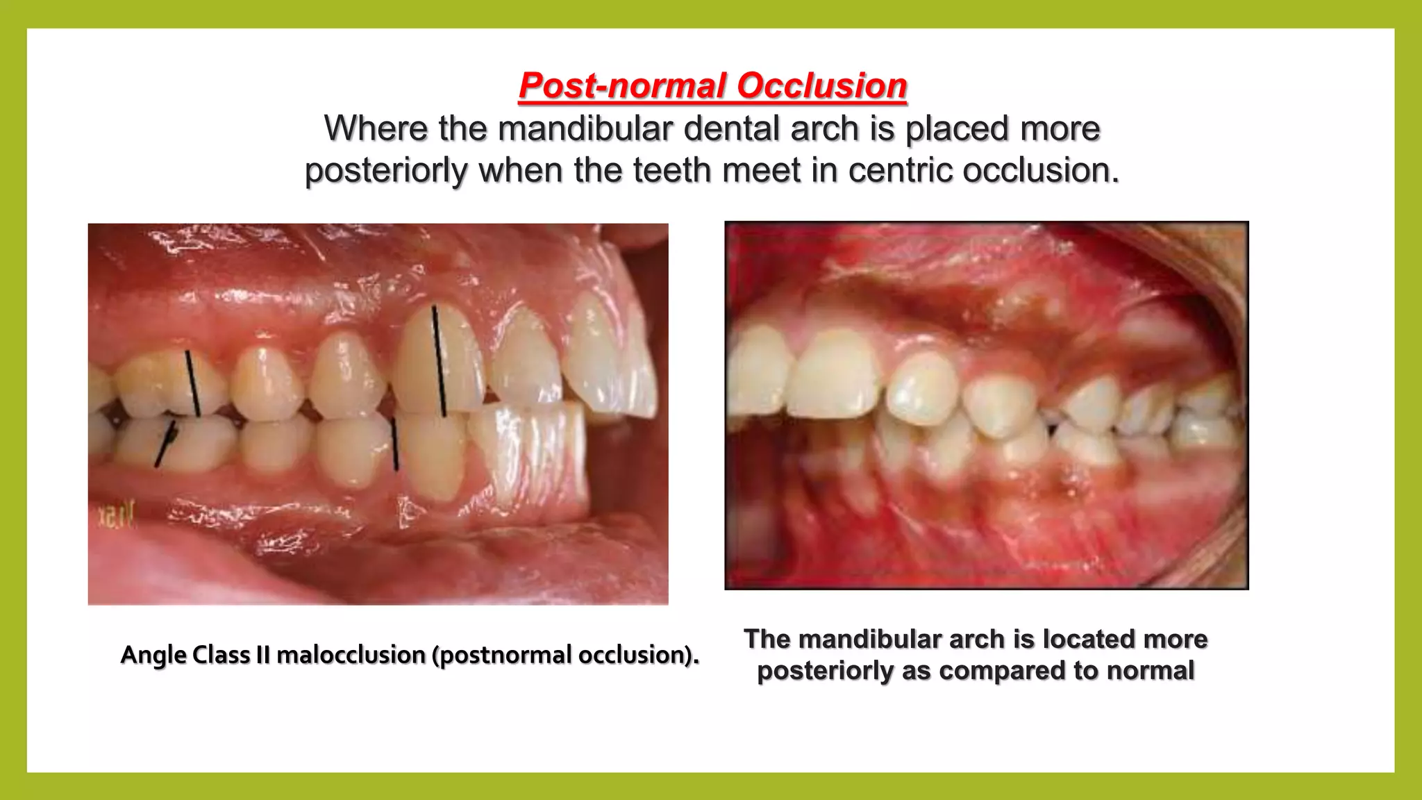 Malocclusion of teeth | PPTX