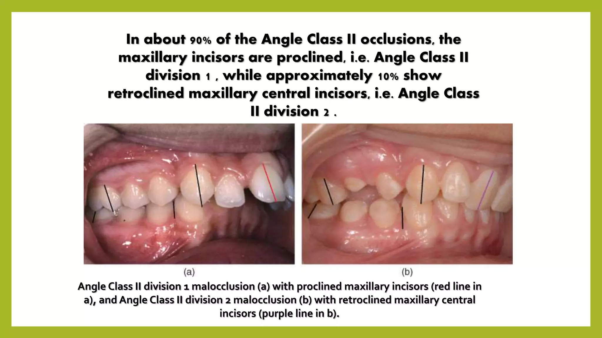 Malocclusion of teeth | PPTX