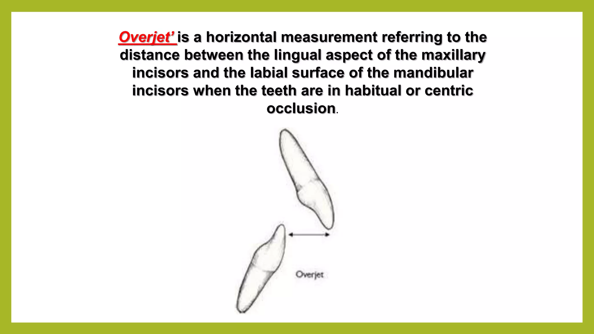 Malocclusion of teeth | PPTX
