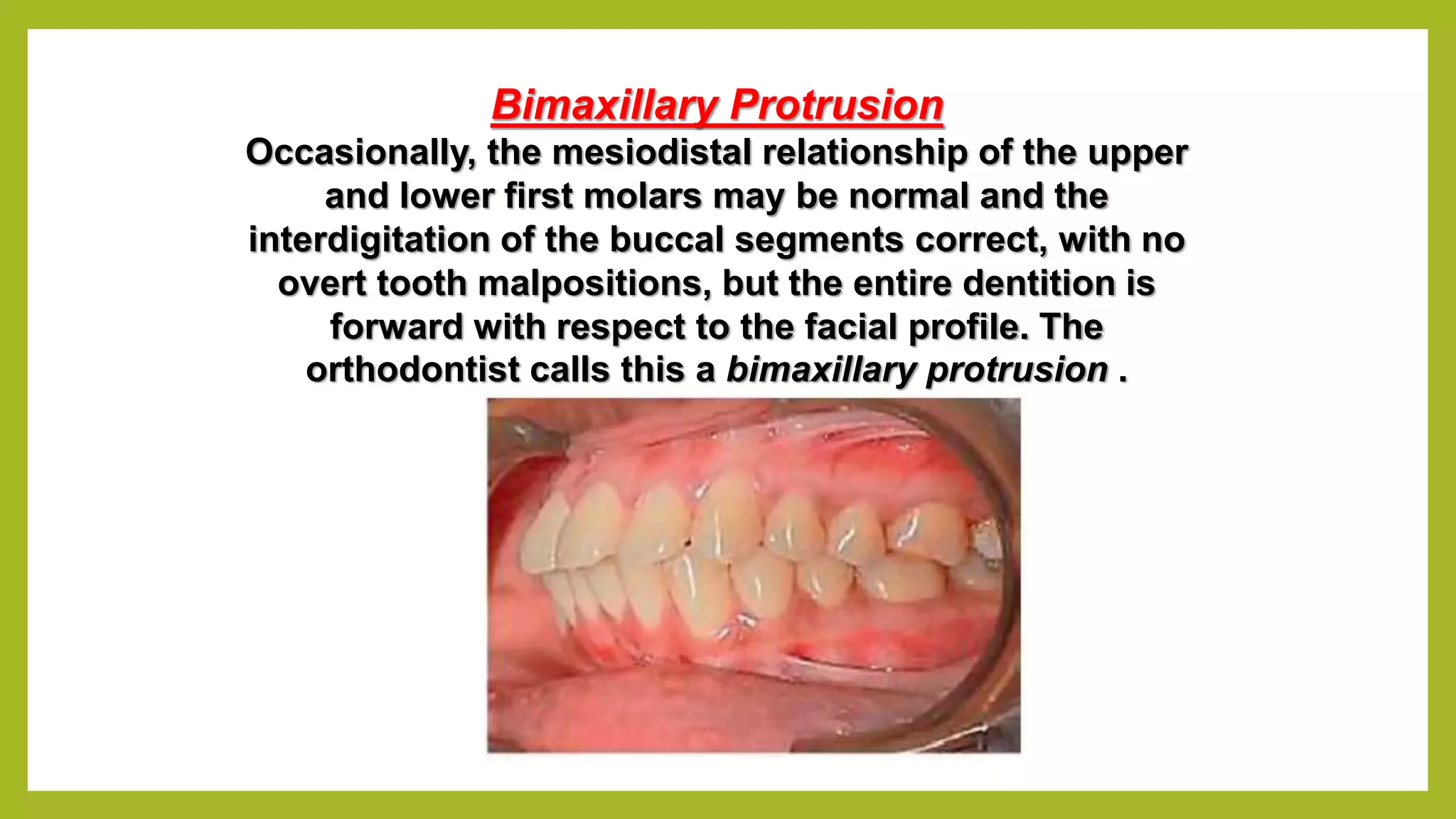 Malocclusion of teeth | PPTX