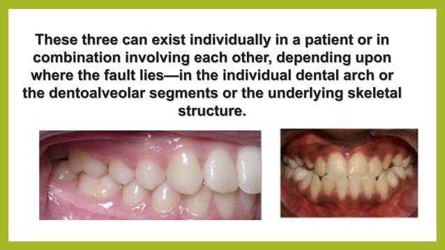 Malocclusion of teeth | PPTX
