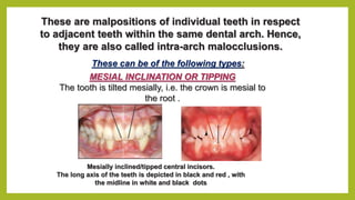 Malocclusion of teeth | PPTX
