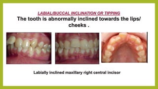 Malocclusion of teeth | PPTX