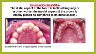 Malocclusion of teeth | PPTX