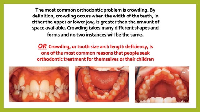 Malocclusion of teeth | PPTX