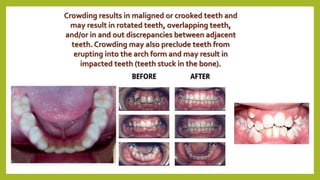 Malocclusion of teeth | PPTX