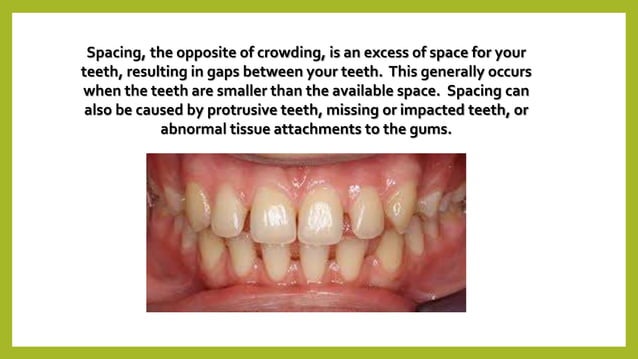 Malocclusion of teeth | PPTX