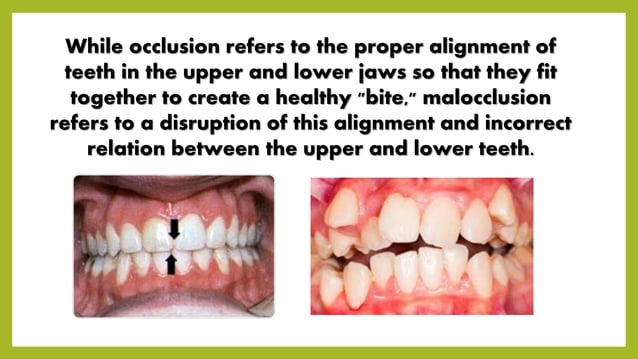 Malocclusion of teeth | PPTX