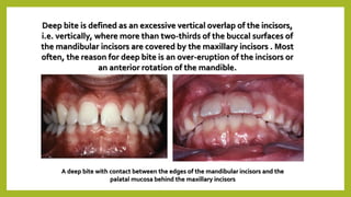 Malocclusion of teeth | PPTX