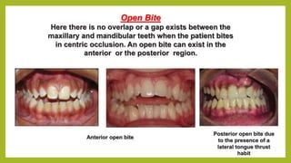 Malocclusion of teeth | PPTX
